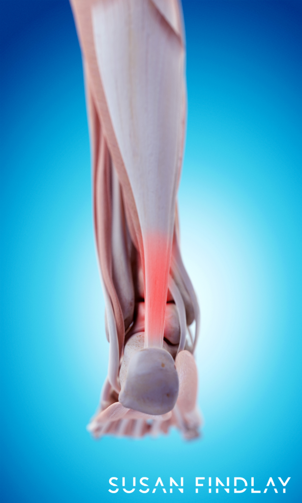 The Use of Massage Therapy for Tendinitis/ Tendinopathy - Susan Findlay